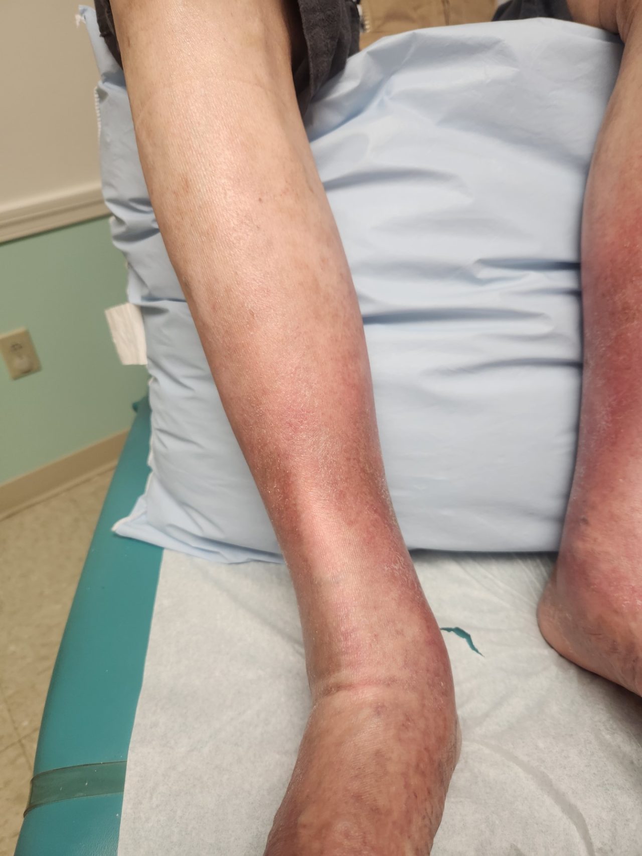 Venous Ulcers - Dr. Nightingale, Clinics in Maine and Vermont