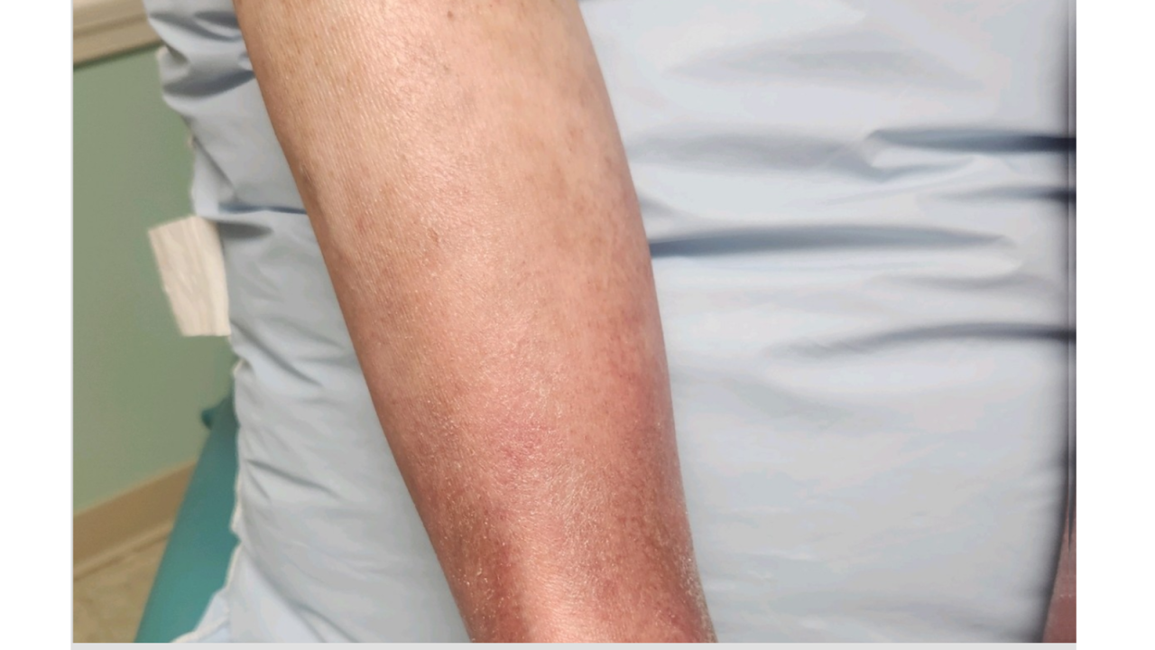 Venous Ulcers - Dr. Nightingale, Clinics in Maine and Vermont