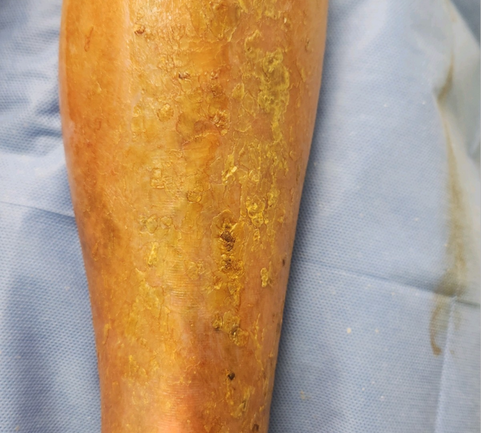 Venous Ulcers - Dr. Nightingale, Clinics in Maine and Vermont